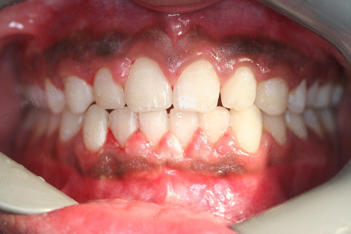 Case 33: Nonextraction treatment with bite jumping appliance | Teeth N ...