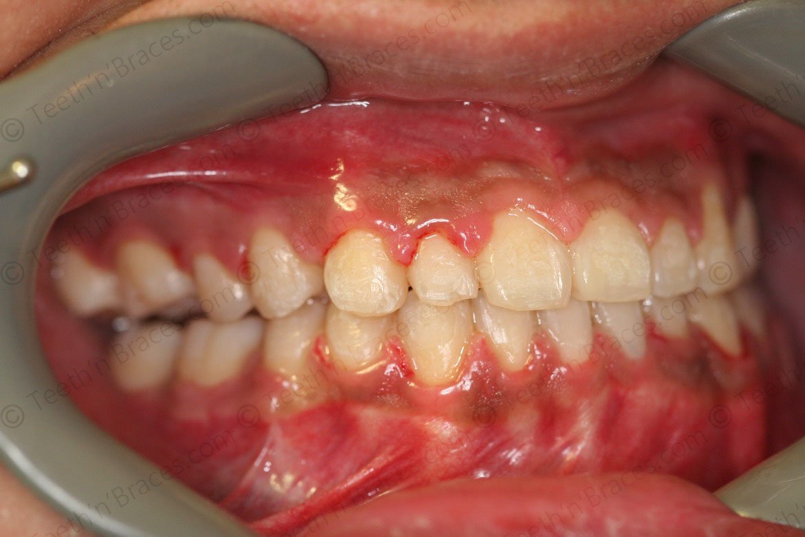 Case 37: Prognathic lower jaw, Surgical- Orthodontics | Teeth N Braces