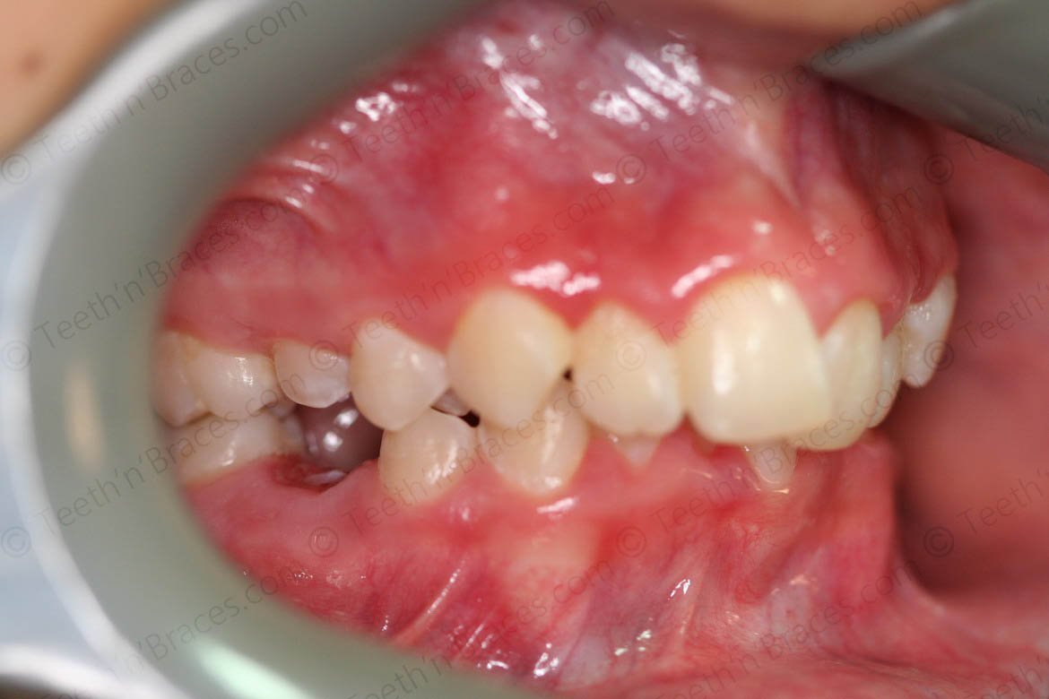 Case 12: Overlapping and “big” front teeth | Teeth N Braces