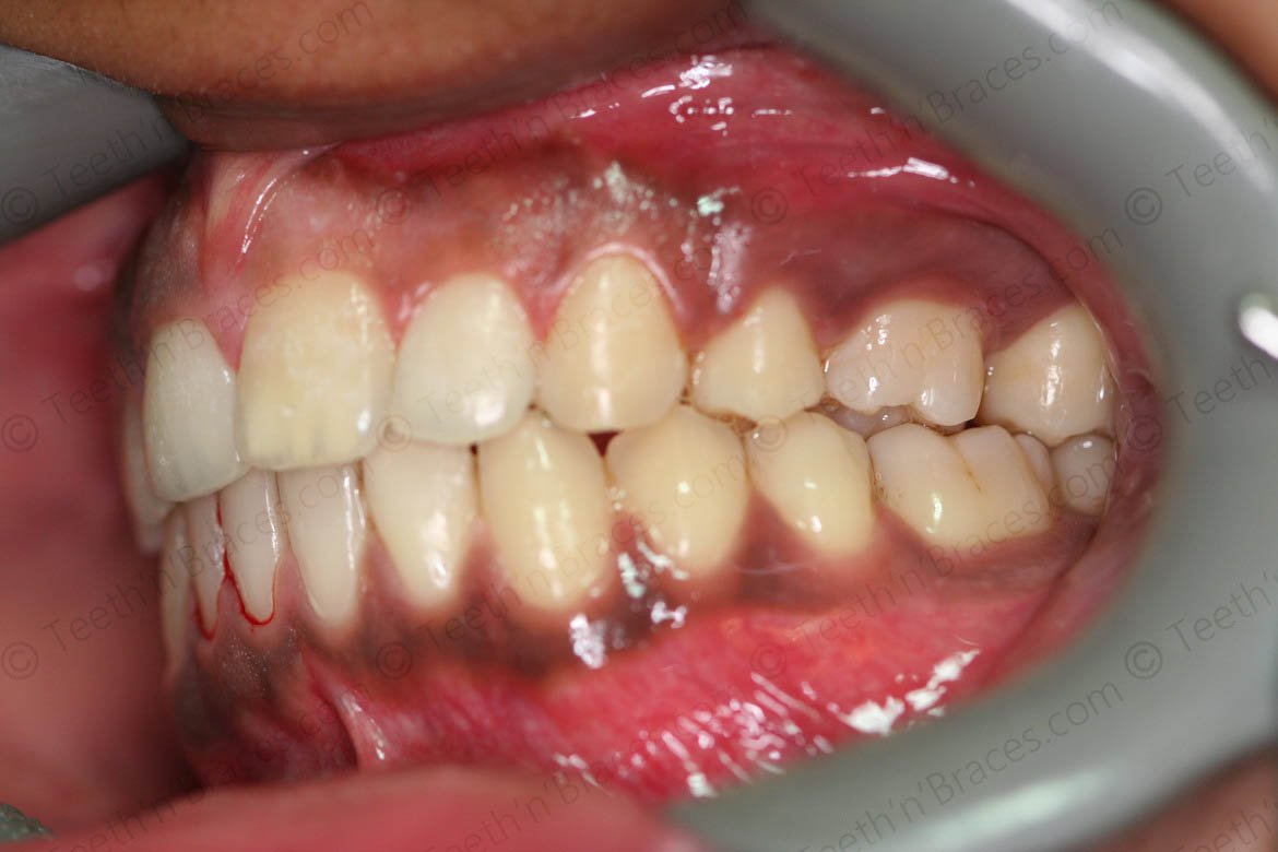 Case 17: Protrusive upper incisors | Teeth N Braces