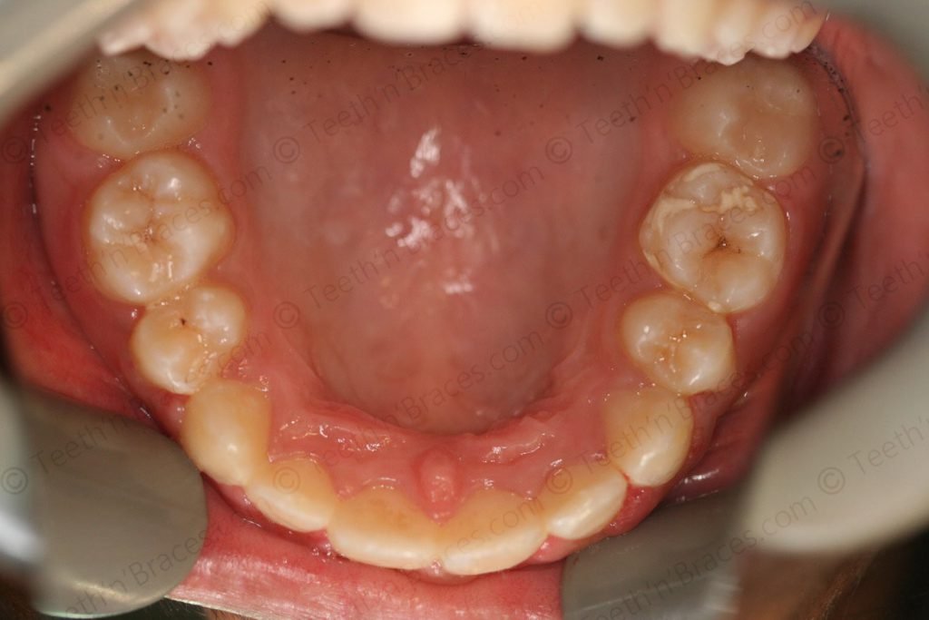 Case 25: Protrusive upper front teeth | Teeth N Braces