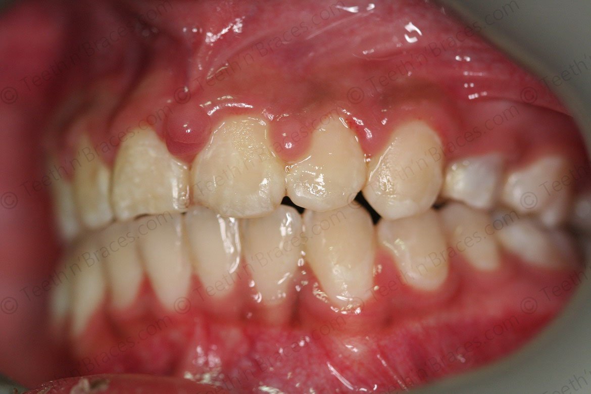Case 28: Severely protruded upper teeth | Teeth N Braces