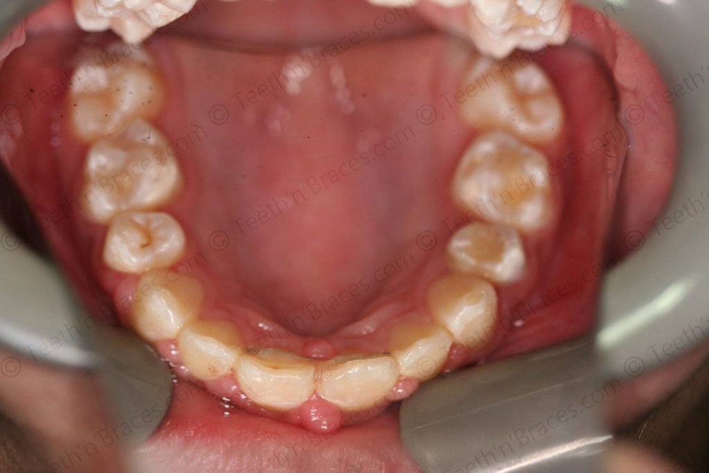 Case 28: Severely protruded upper teeth | Teeth N Braces