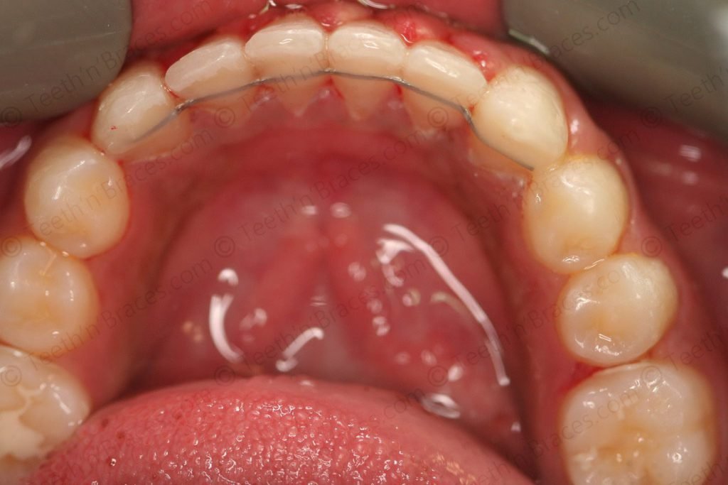 Case 33: Nonextraction treatment with bite jumping appliance | Teeth N ...