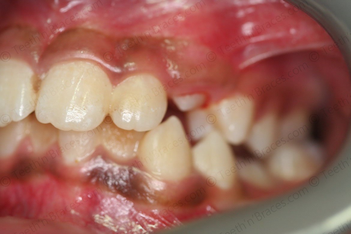 6 | Teeth N Braces